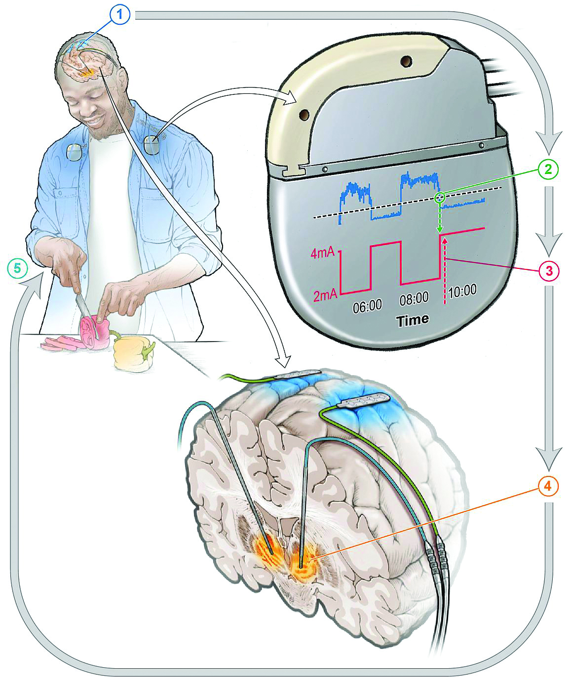 healthHQ | Innovative Brain Pacemaker Technique Demonstrates Improved ...